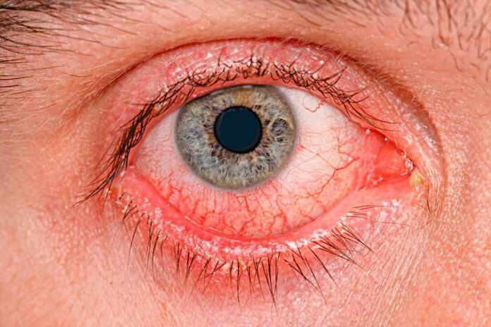 Enfermedades oculares más comunes - MegaCLUB